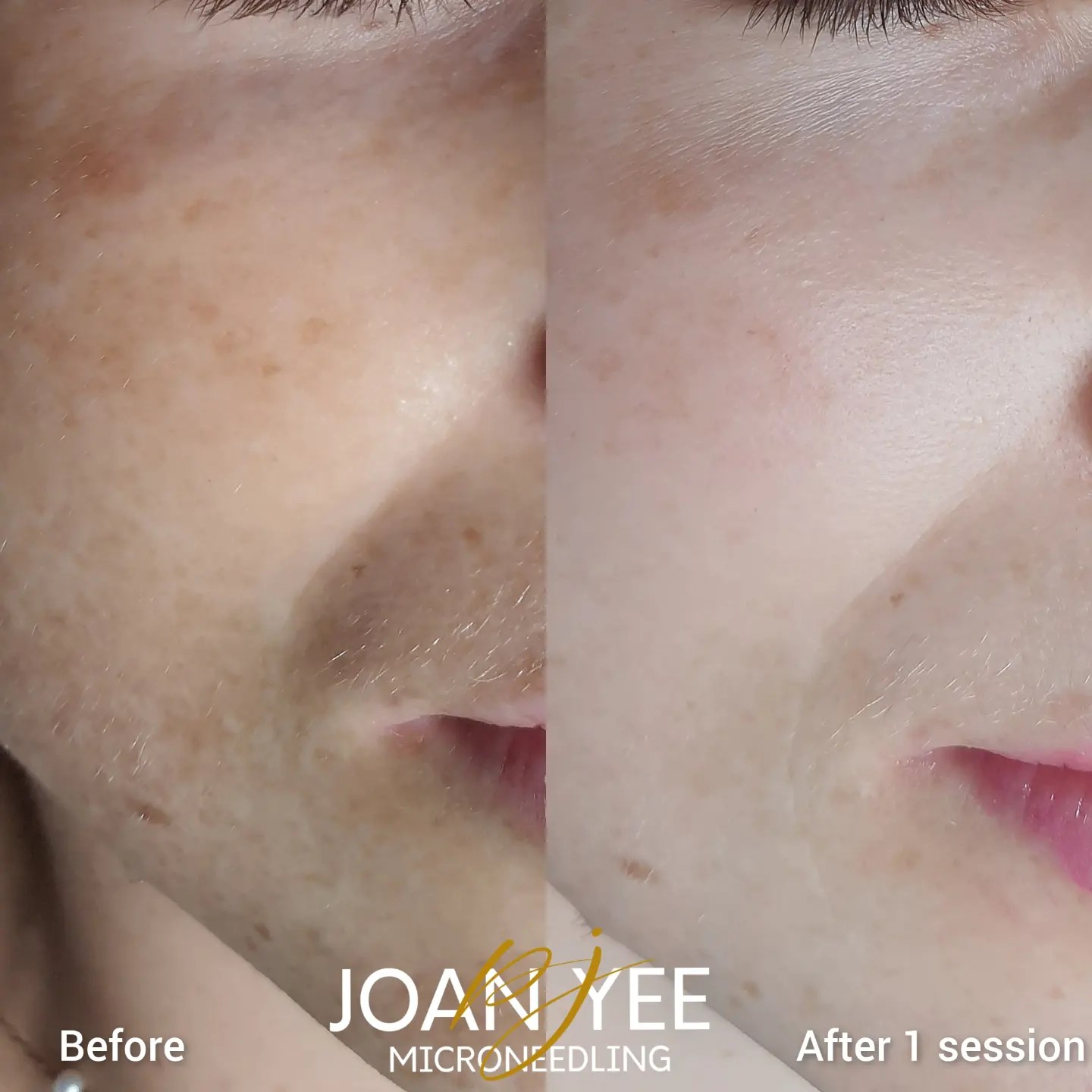 Microneedling (MTS) – Skin and Permanent Makeup Specialists