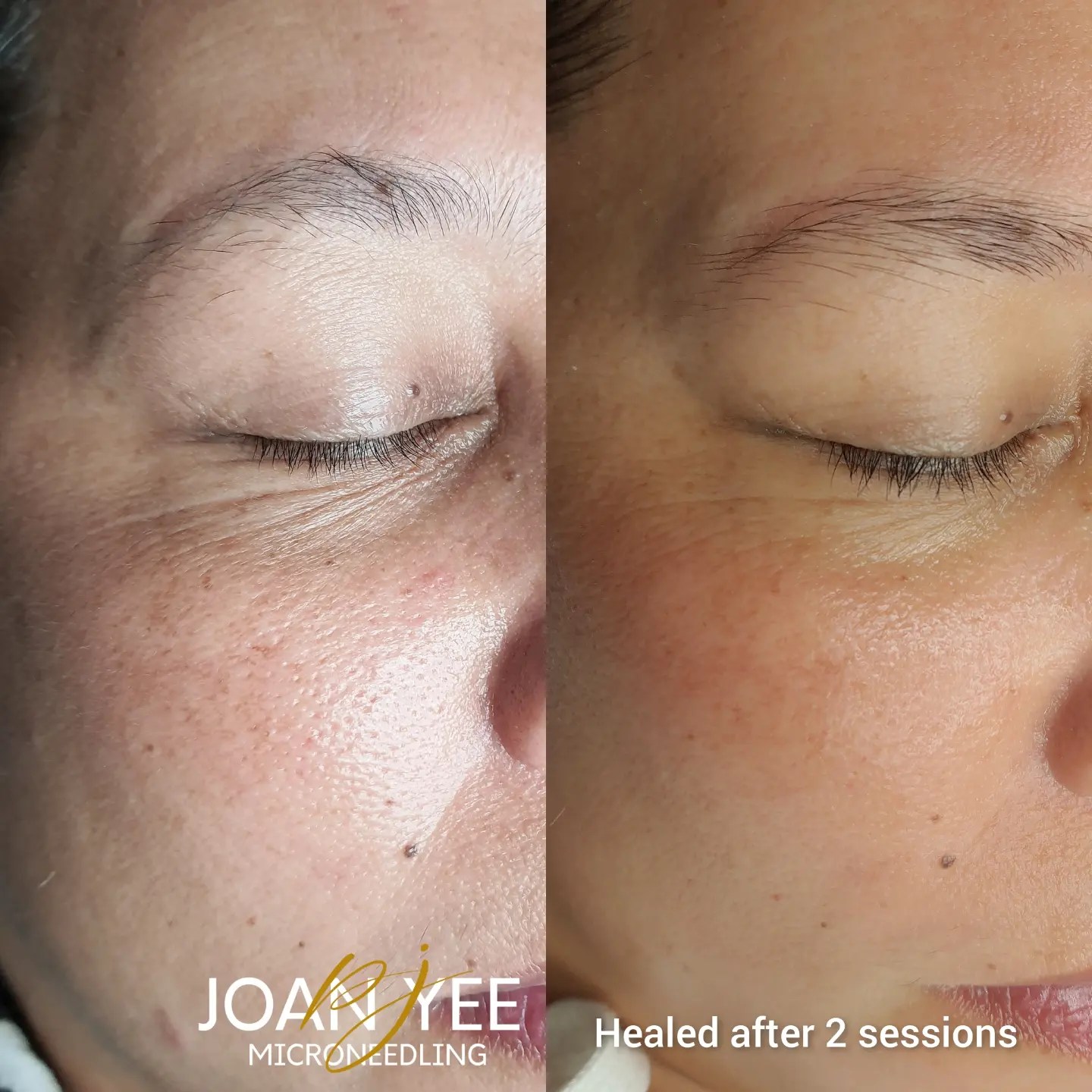 Microneedling (MTS) – Skin and Permanent Makeup Specialists