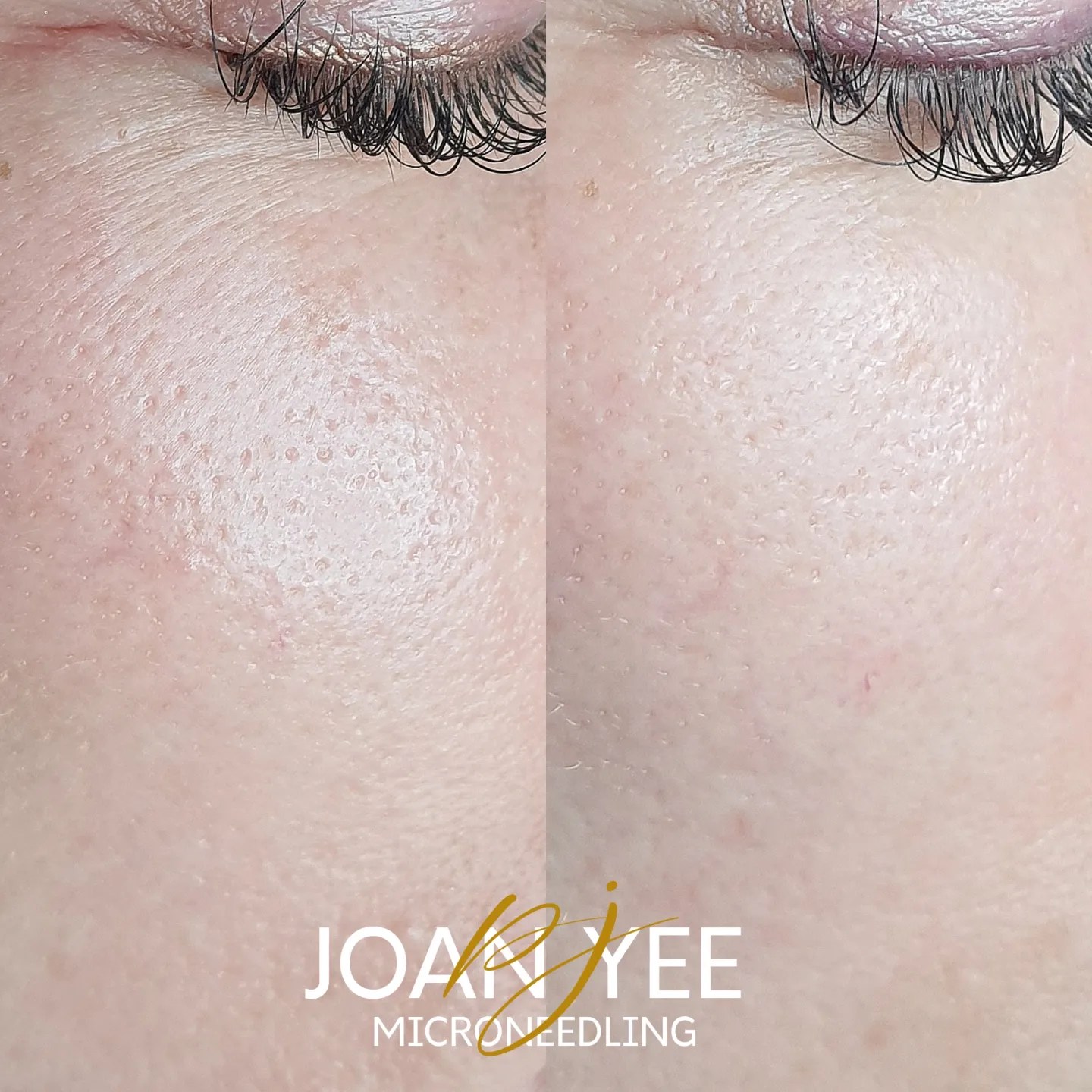 Microneedling (MTS), Bangkok – Skin and Permanent Makeup Specialists